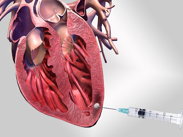 Intracardiac Injection Human