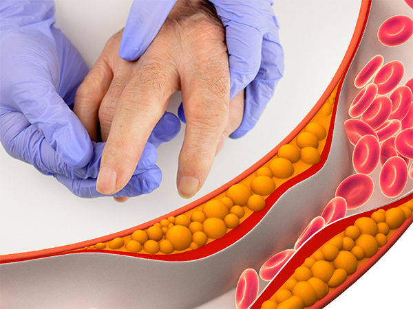 No Increased CVD Risk With IL-6 Blocker in RA - CRTonline