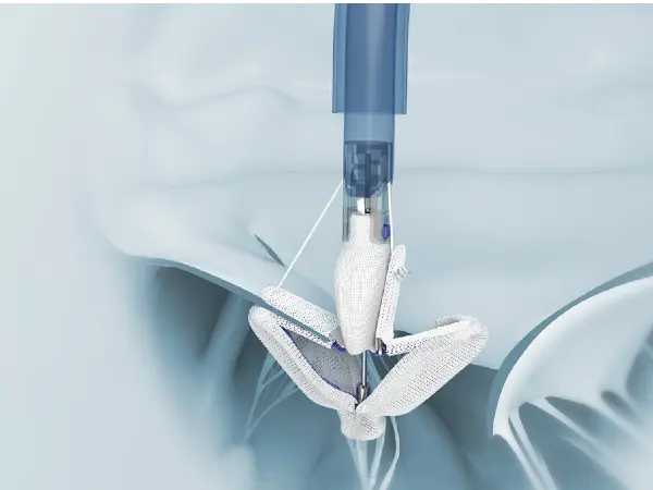 PASCAL System Contributes to TR Improvements and Higher QOL, Say ...